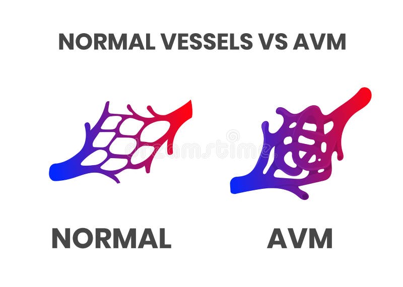 Normal Vessels And Arteriovenous Malformation Avm Stock Vector ...