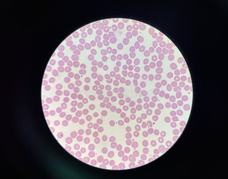 Normalchromic Normocytic Red Blood Cell Stock Image - Image of anatomy ...