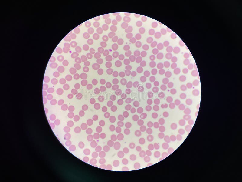 Normalchromic Normocytic Red Blood Cell Stock Photo - Image of ...