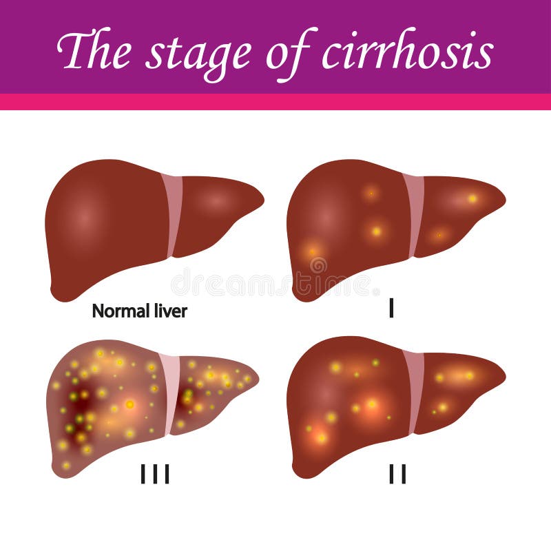 De cirrose van de lever stock illustratie. Illustratie bestaande uit ...