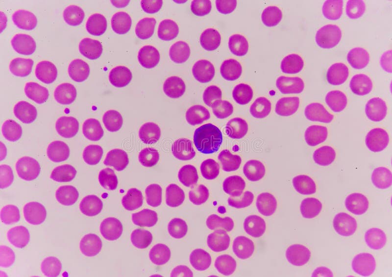 Normochromic Normacytic Red Blood Cells Stock Photo - Image of ...