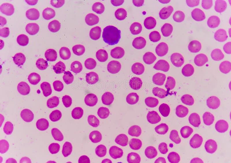 Normochromic Normacytic Red Blood Cells Stock Photo - Image of ...