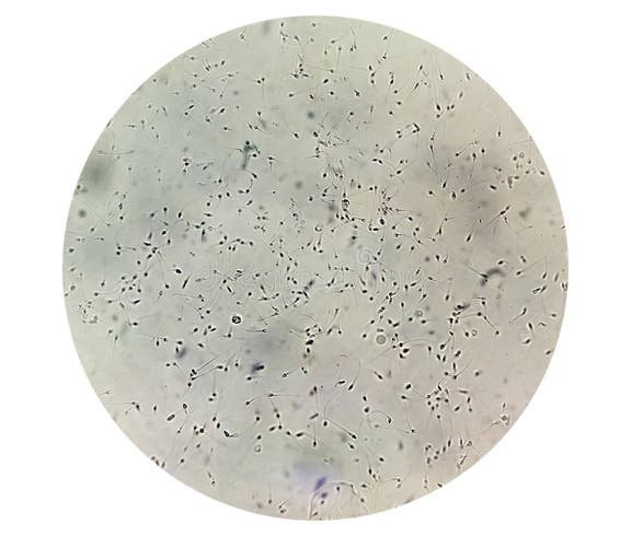 Normozoospermia Analyzed by Microscope Stock Photo - Image of observed ...