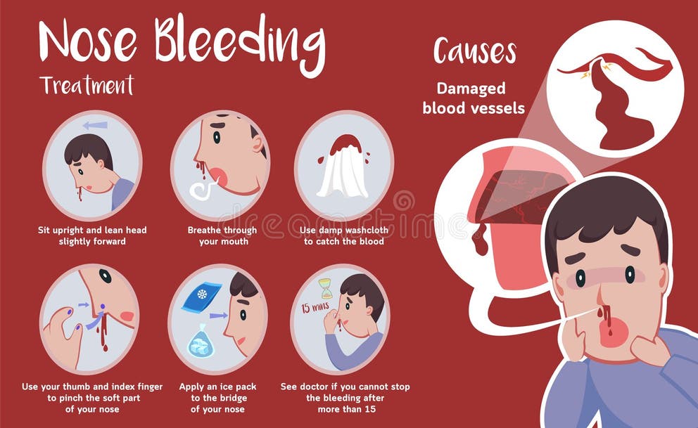 Nose Bleeding Cartoon Vector Stock Vector - Illustration of bleed ...