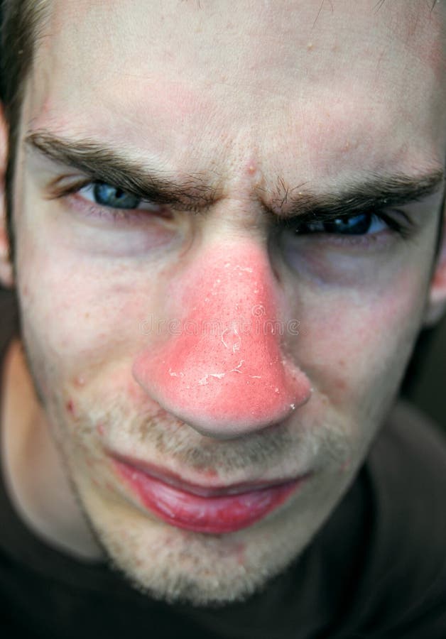 Nose Sunburn Stock Image Image Of Face Affected Male 18432291