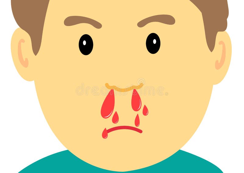 Nosebleed Stock Illustrations – 148 Nosebleed Stock Illustrations, Vectors & Clipart - Dreamstime