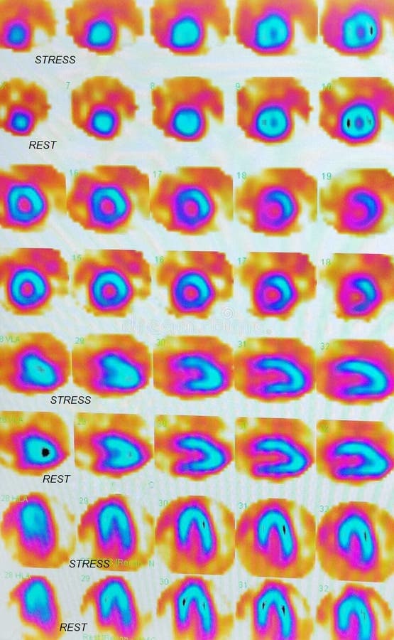 Nuclear Myocardial Perfusion Stress Test Stock Photo - Image of ...