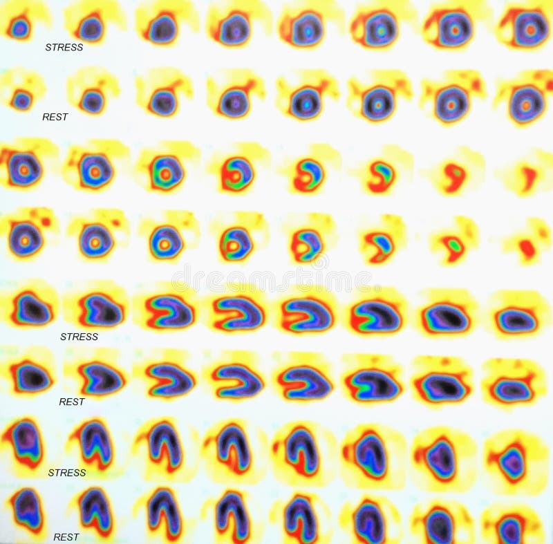 Nuclear Stress Test Stock Photos - Free & Royalty-Free Stock Photos ...