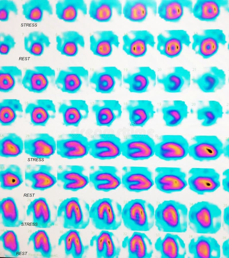 Nuclear Myocardial Perfusion Stress Test Stock Image - Image of rest ...