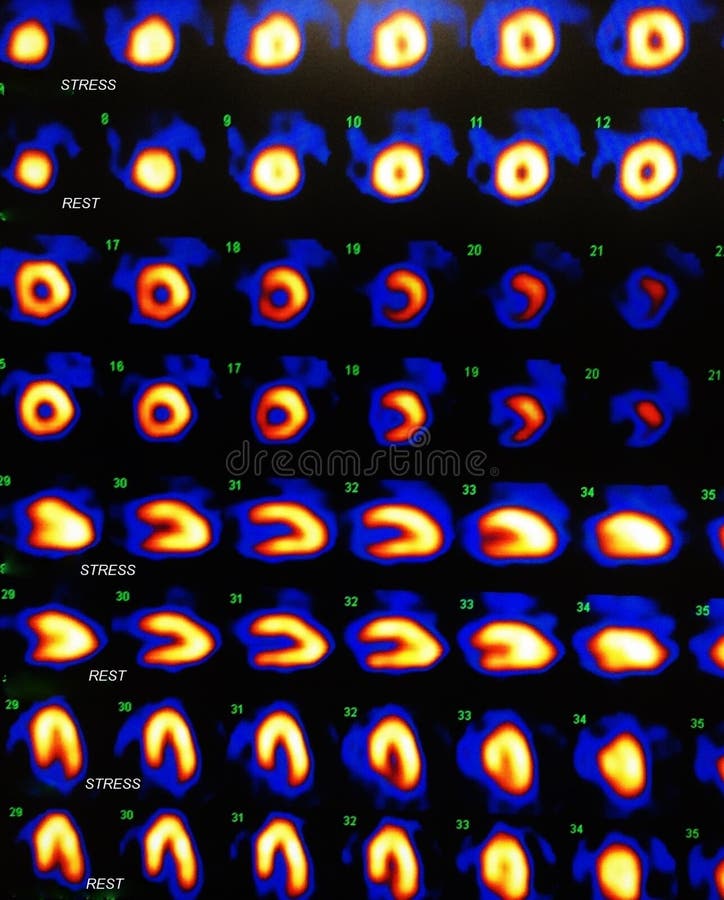 Nuclear Myocardial Perfusion Stress Test Stock Photo - Image of exam ...