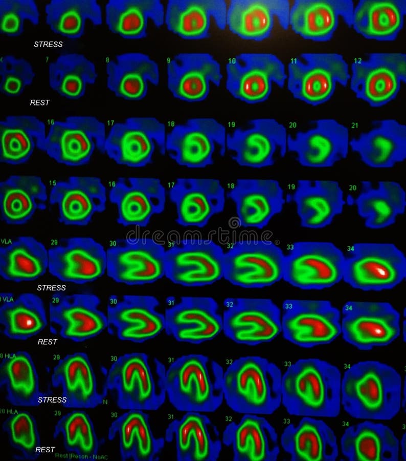 Nuclear Myocardial Perfusion Stress Test Stock Photo - Image of check ...