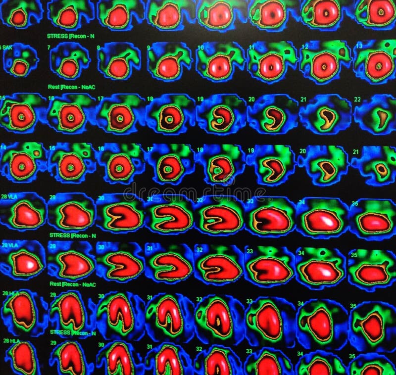 Nuclear Myocardial Perfusion Stress Test Stock Photo - Image of ...