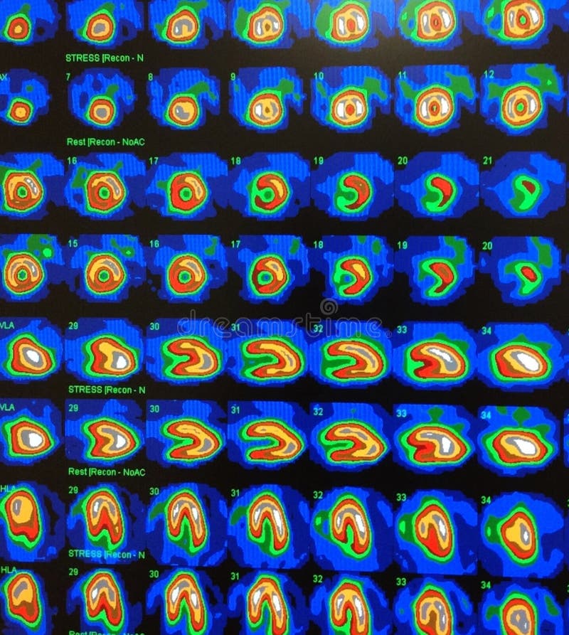 Nuclear Myocardial Perfusion Stress Test Stock Photo - Image of check ...
