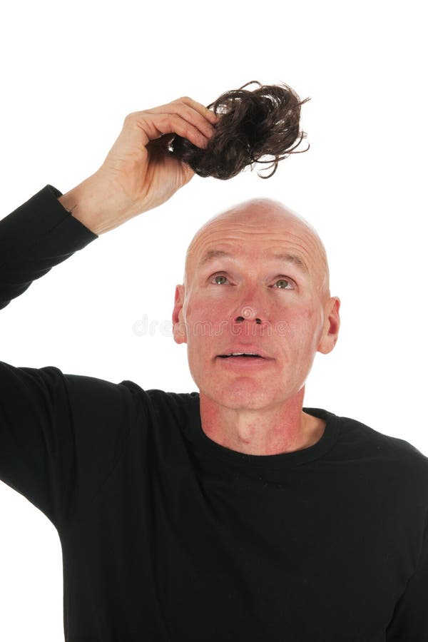 Nuevo Pelo Para El Hombre Calvo Foto de archivo - Imagen de hombre ...