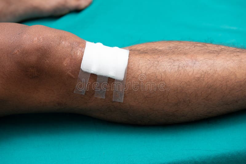 Nurses make leg ulcers stock image. Image of hand, bandage - 124423179