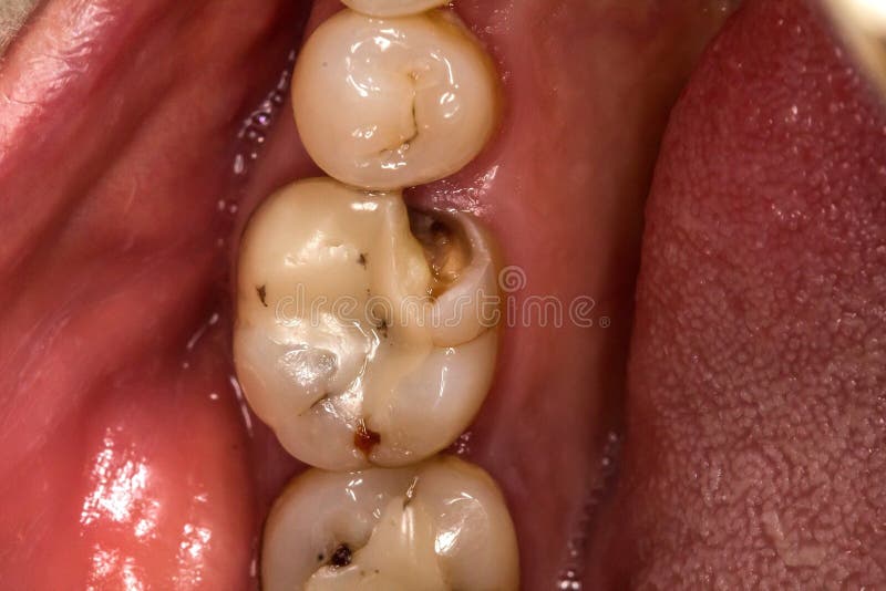 O Molar No Curso Da Restauração Foto de Stock - Imagem de tratamento ...