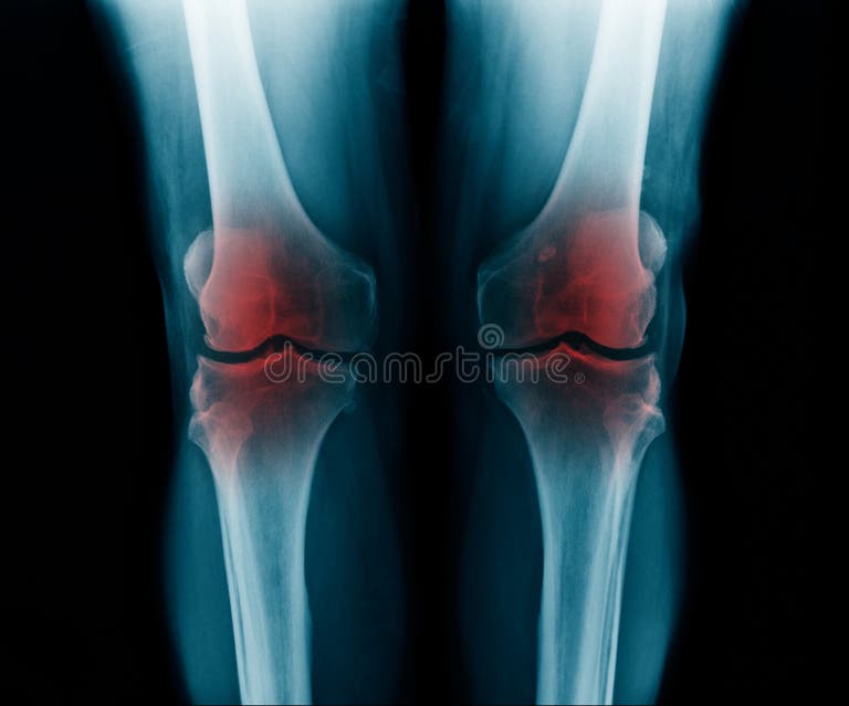 OA knee x-ray stock photo. Image of radiology, injury - 111400442