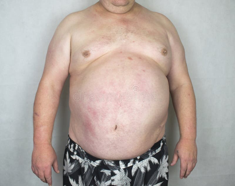 Obesity - Obese Man stock image. Image of diet, cellulite - 86955819