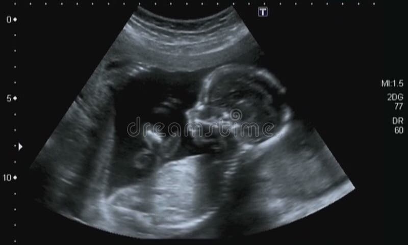 Obstetric Ultrasonography stock photo. Image of inside - 15411898