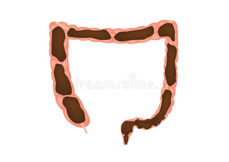 Obstipation Stock Illustrationen, Vektoren, & Kliparts - 148 Stock ...