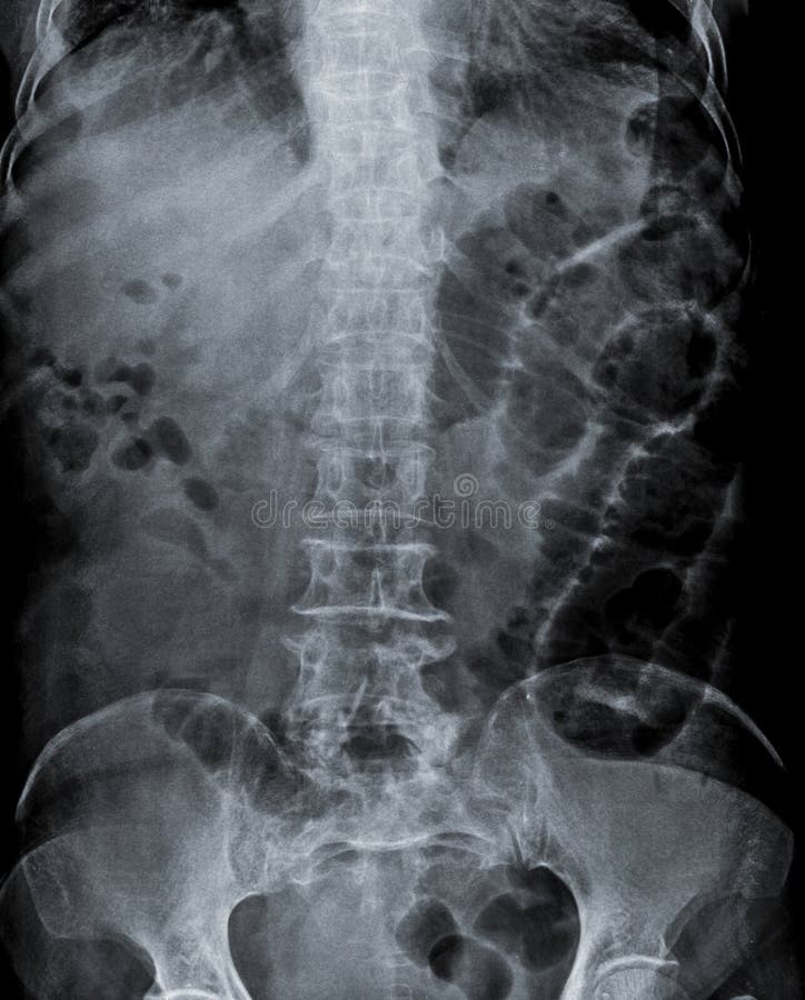 Obstruction Intestinale D'abdomen Humain Image stock - Image du ...