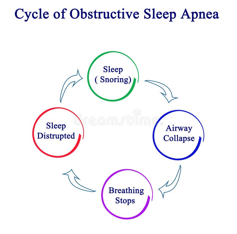 Obstructive Sleep Apnea Stock Illustrations – 338 Obstructive Sleep ...