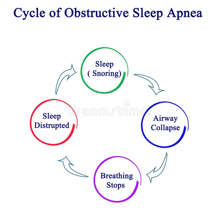 Obstructive Sleep Apnea Stock Illustrations – 310 Obstructive Sleep ...