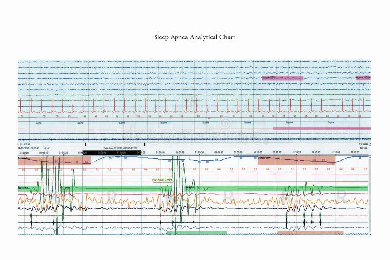 Obstructive Sleep Apnea Symptom Chart from Sleep Test for Doctor To ...