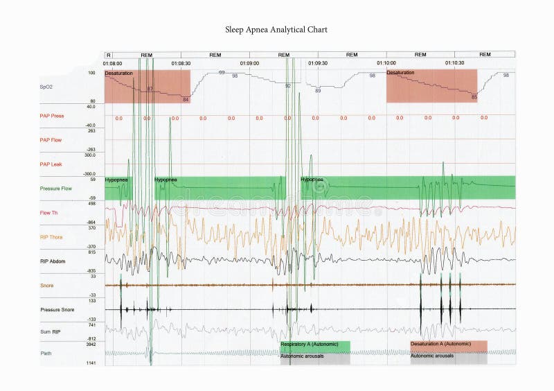 Obstructive Sleep Apnea Symptom Chart from Sleep Test for Doctor To ...