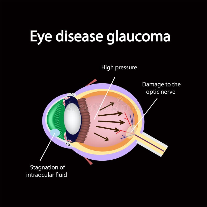 Glaucoma La Struttura Dell'occhio Il Campo Di Visibilità Nel Glaucoma ...