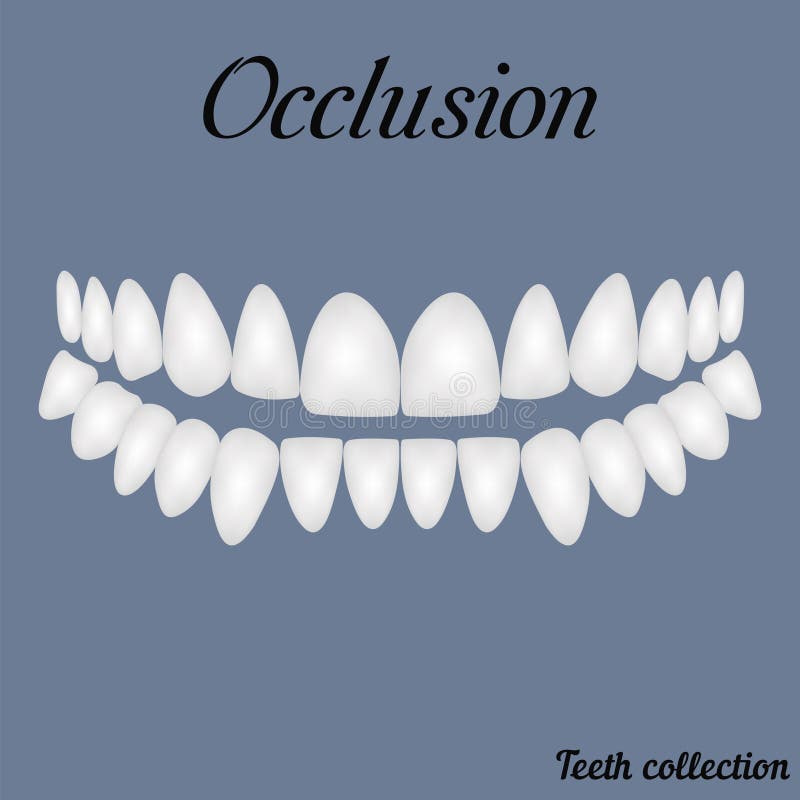 Occlusion stock vector. Illustration of graphic, medical - 71207779