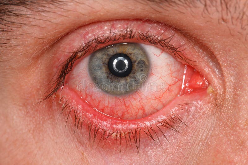 Oeil Chronique De Conjonctivite Photo stock - Image du santé, tête ...