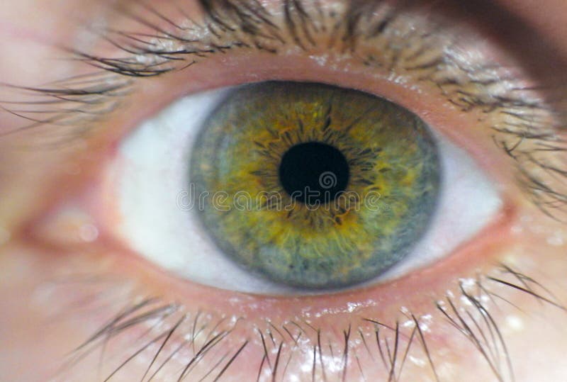 Ictère, Ou Jaunissement De La Sclère De L'œil Dans Les Maladies Du Foie ...