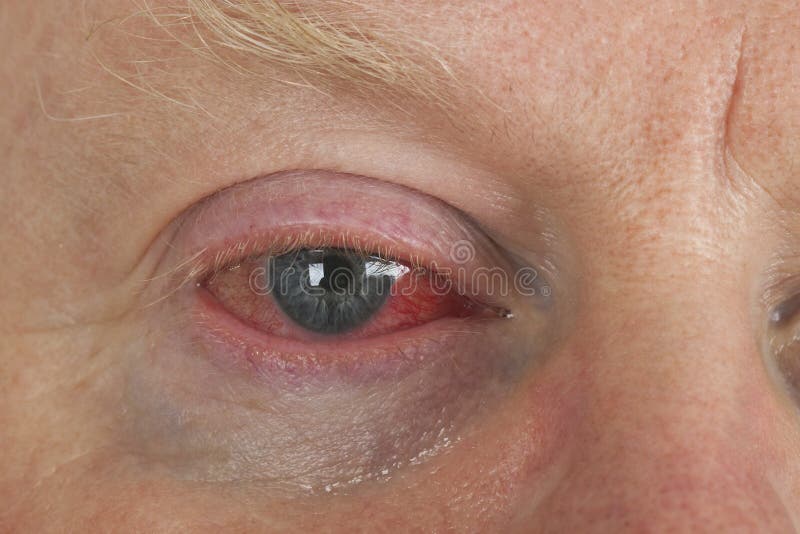 Proche D'un Oeil Injecté De Sang Sévère. État De Conjonctivite De ...