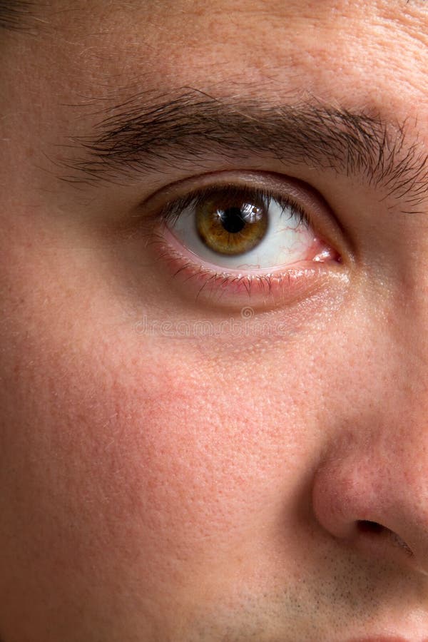 Oeil injecté de sang image stock. Image du sang, injecté - 14810621