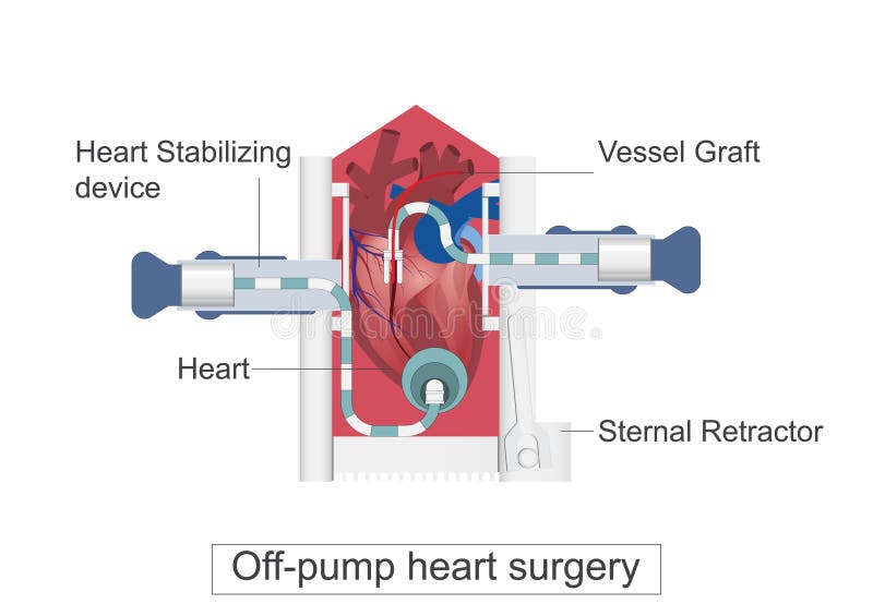Off-pump Heart Surgery is a Type of Coronary Artery Bypass Surgery ...