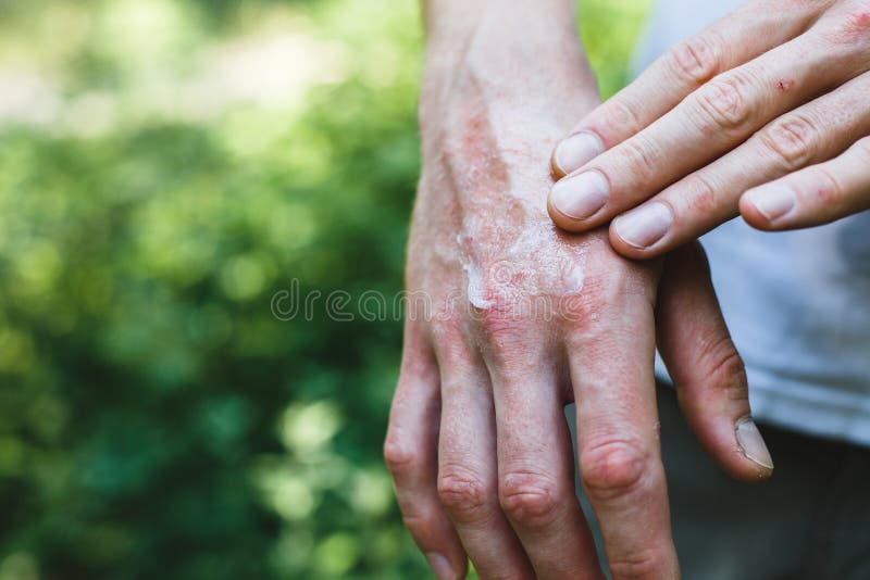 Ointment on Hand. Applying the Ointment in the Treatment and Hydration ...