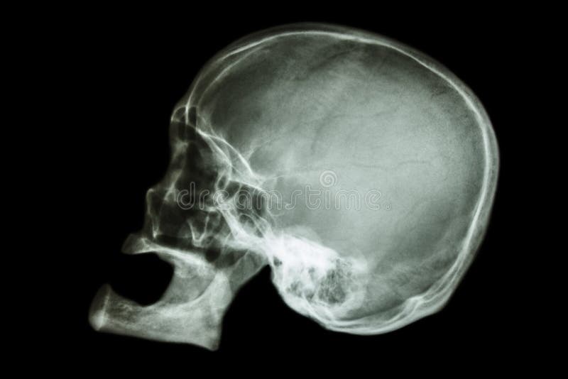 Skull No Jaw Photos - Free & Royalty-Free Stock Photos from Dreamstime