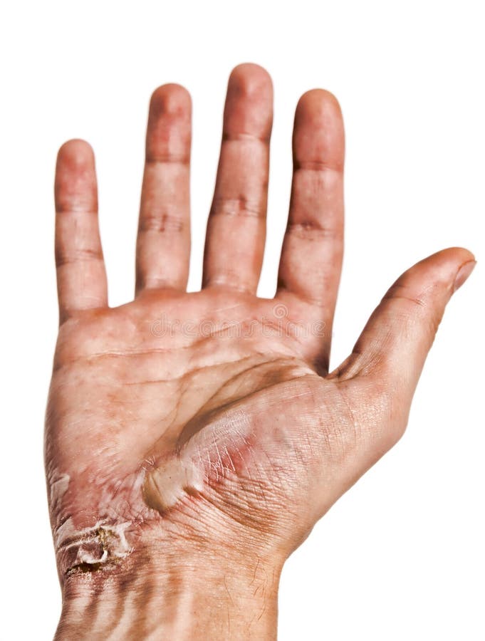 Old damaged hand stock photo. Image of unhealthy, poverty - 7290796