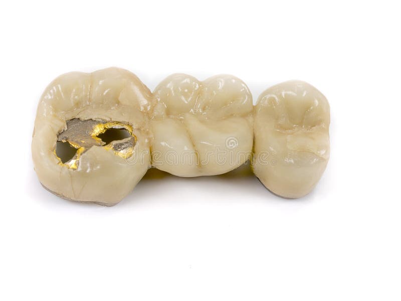 Old dental gold stock image. Image of golden, caries - 61543107