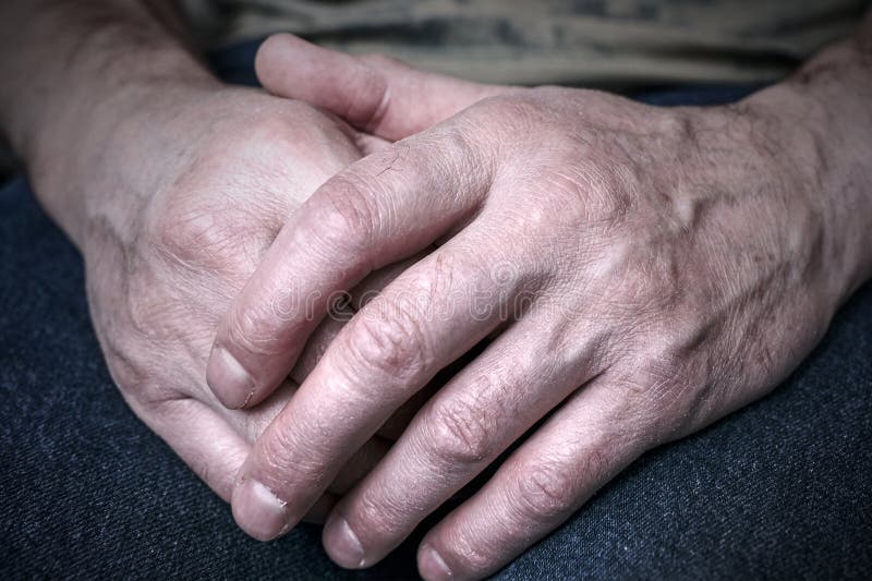 Old Hands. Senile Spots, Liver Spots, Age Pigmentation. Stock Photo ...