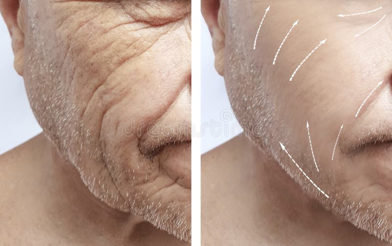 Old Man Face Effect Wrinkles Arrow before and after Procedures Stock ...