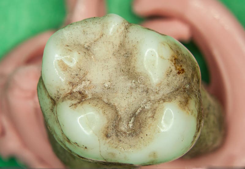 Old molars of humans stock image. Image of green, humans - 192981309