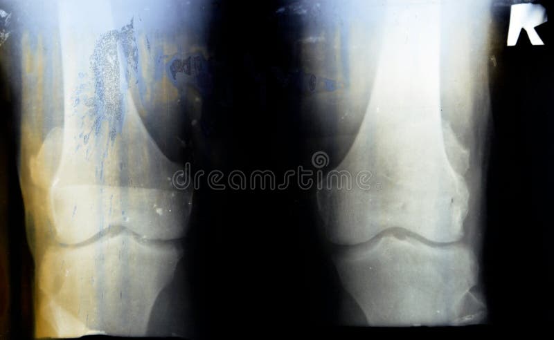 Old Retro Plain X Ray of the Right Knee Shows Apparent Joint ...