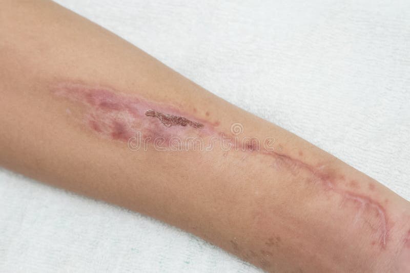 Scar On His Forearm, Scalding With Boiling Water Stock Photo - Image of ...