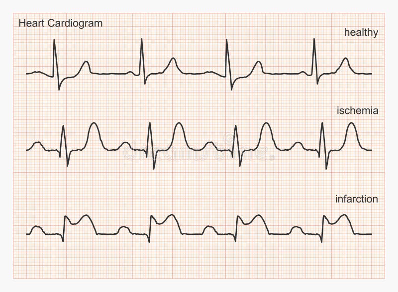 Ondas Do Cardiograma Do Coração Ilustração do Vetor - Ilustração de ...