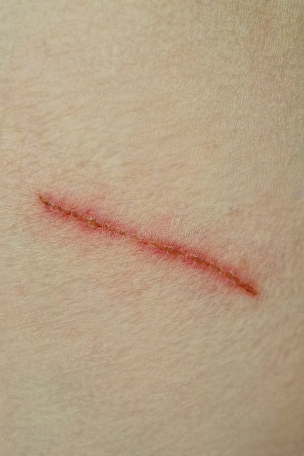One Red Long Scratch Cut on Gray Skin Stock Image - Image of closeup ...