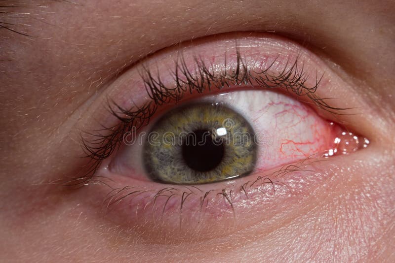 Bindvliesontsteking. Macro. Het Ontstoken Oog Stock Foto - Afbeelding ...