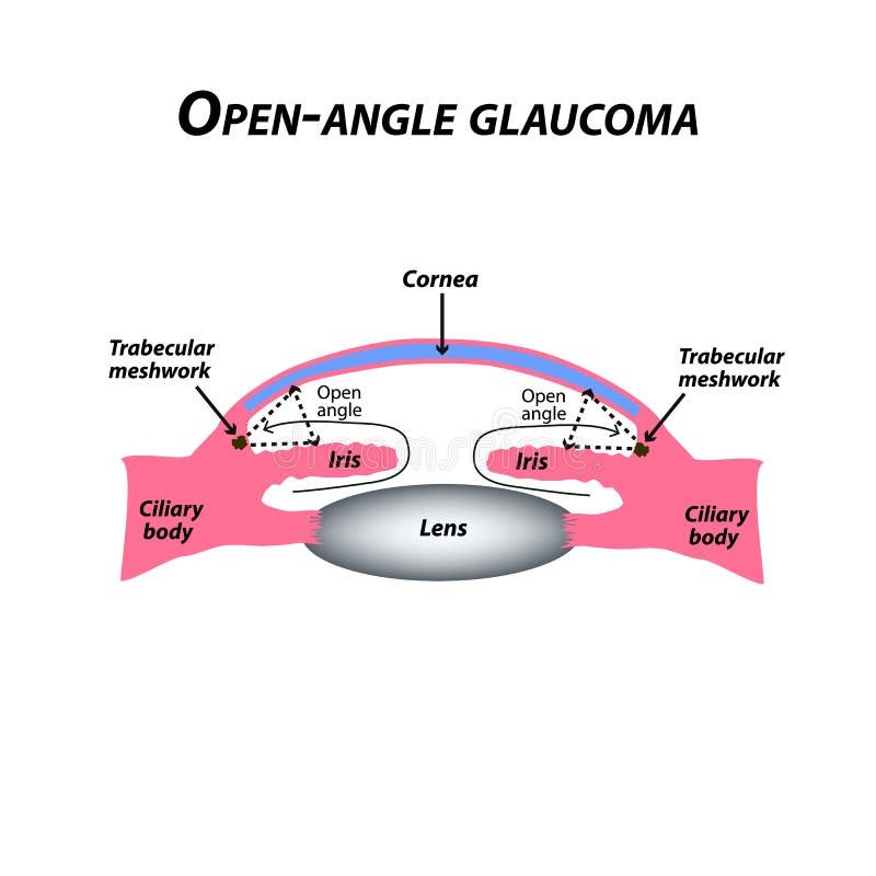 Open-angle Glaucoma. a Common Type of Glaucoma. the Anatomical Structure of the Eye ...