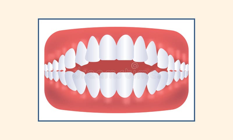 Open Bite Teeth Icon Against Yellow Stock Illustration - Illustration ...